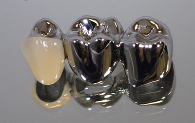 Brücke:Vollguss | Dental Studio Feindler GmbH